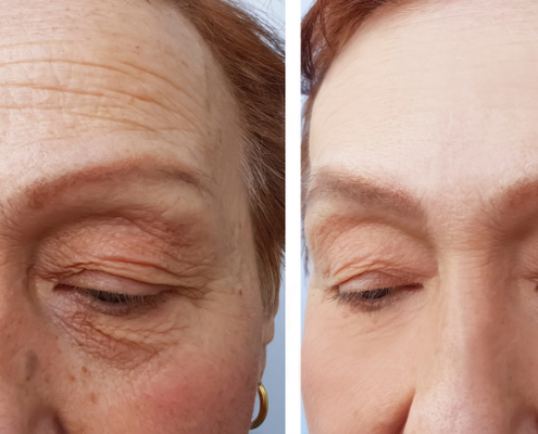 Tear Troughs Training Course - Chaelis SChool of Aesthetics